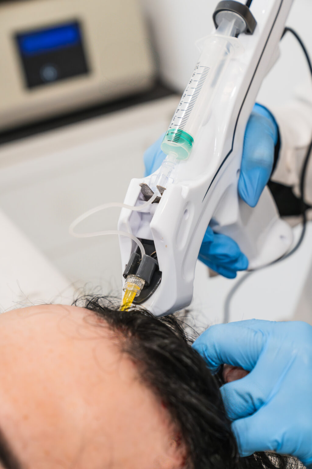 PRP vs SVF for Hair Loss: Which Treatment Works Best?